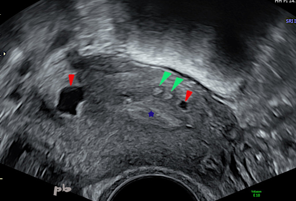 Adénomyose – Page 1 – CGLRE